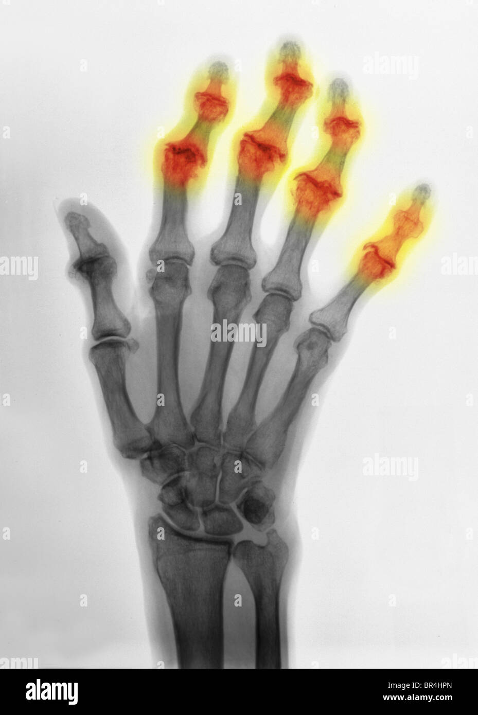 Osteoarthritis Hand Xray Before And After Rheumatoid Arthritis Surgery