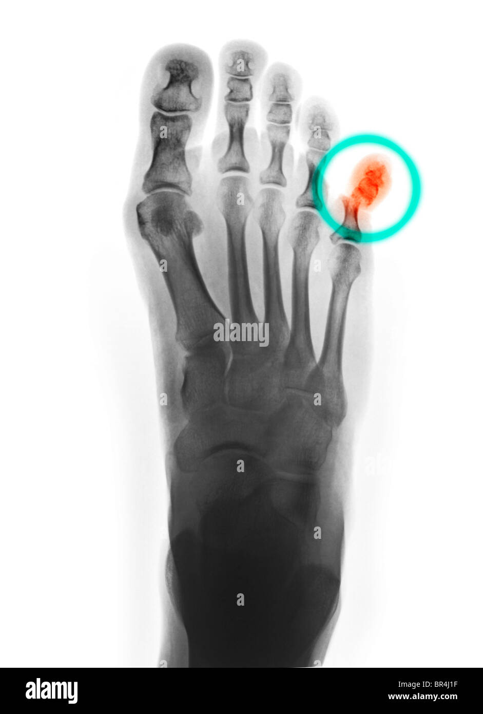 Toe foot anatomy High Resolution Stock Photography and Images - Alamy