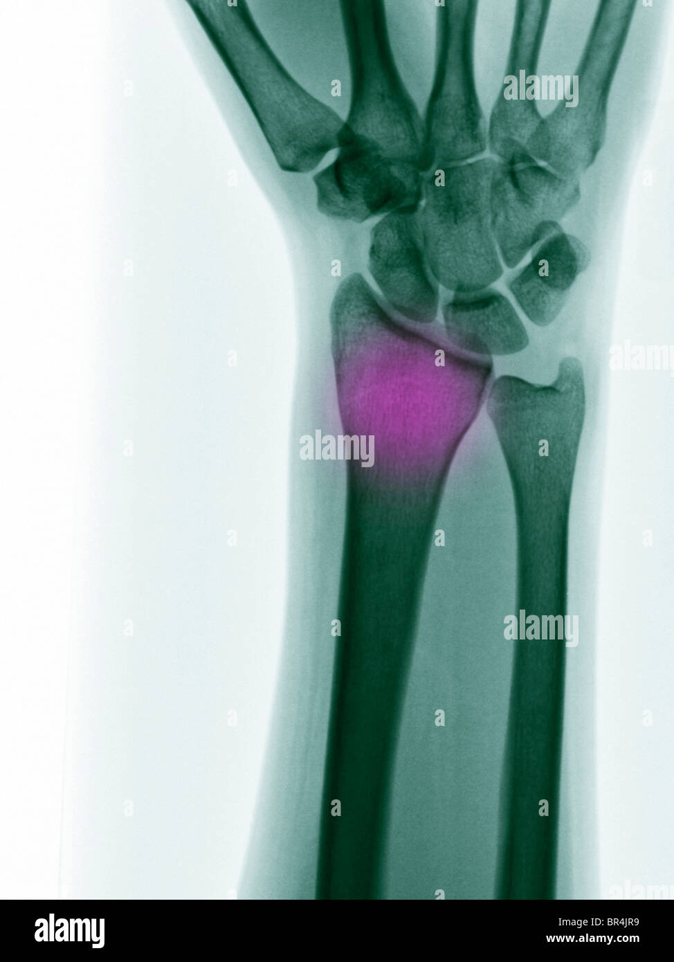 Forearm x-ray of a 29 year old female showing a non-displaced fracture ...