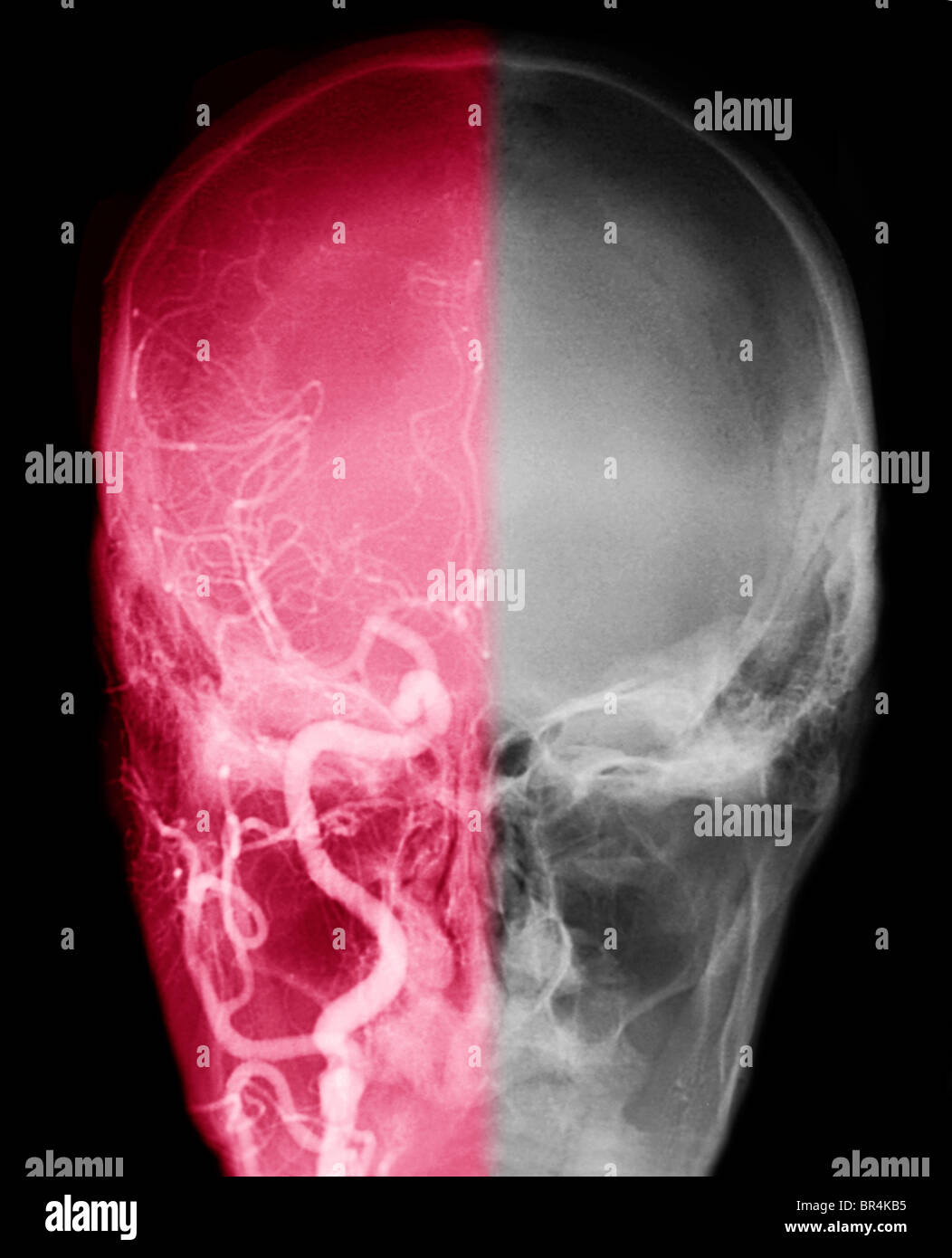 Cerebral angiogram hi-res stock photography and images - Alamy