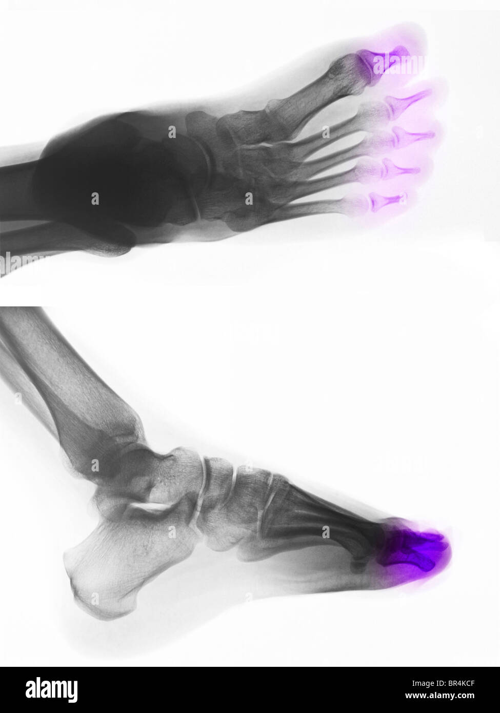 Foot x-ray of a 25 year old man showing congenital absence of the ...