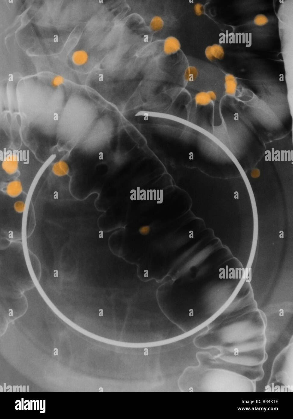 Barium enema x ray hi-res stock photography and images - Alamy