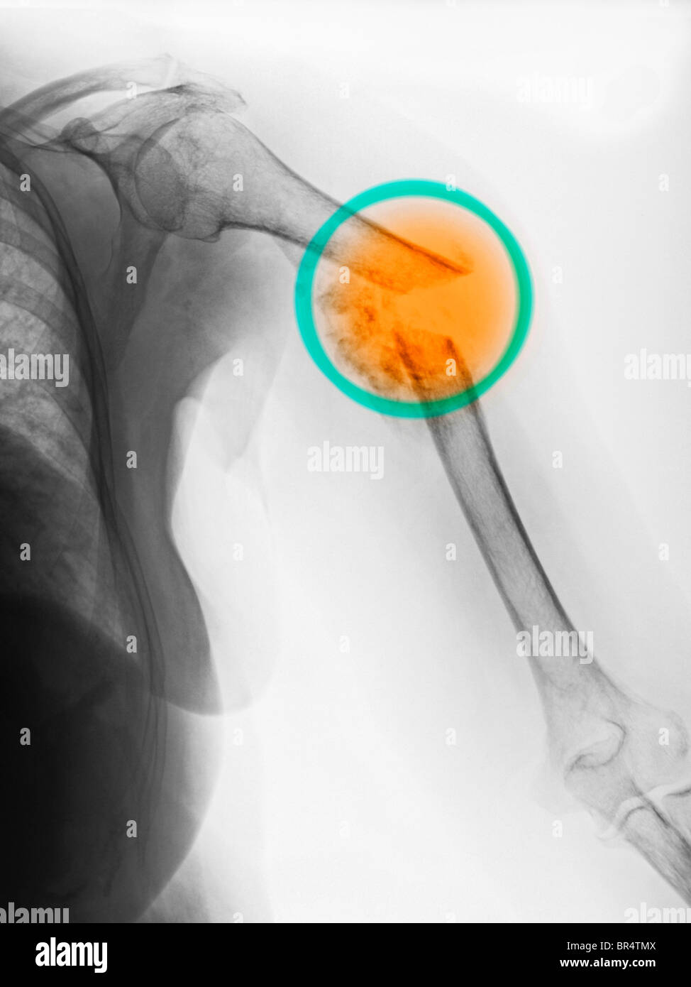 Humerus fracture hi-res stock photography and images - Alamy