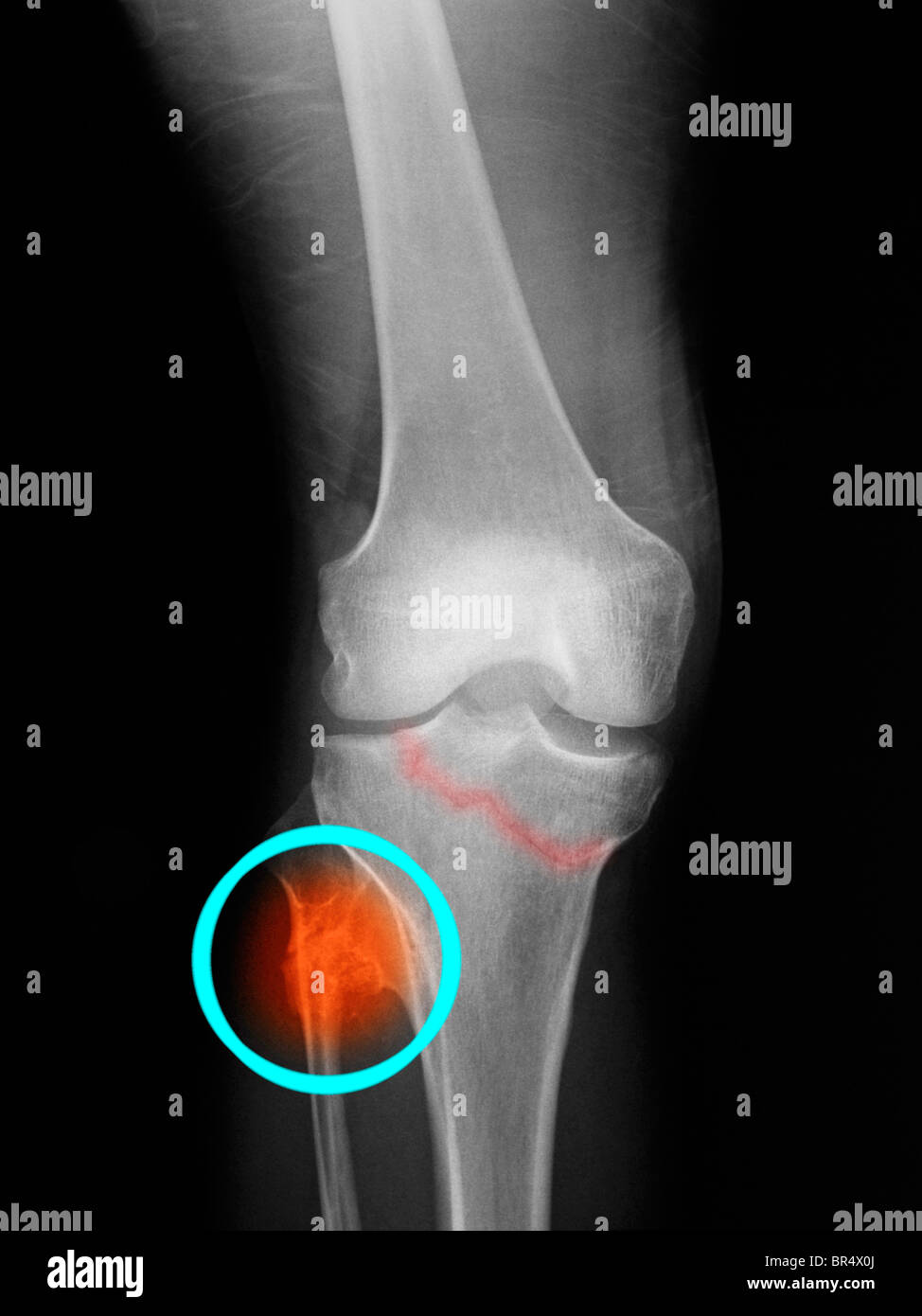 Fibula Proximal Proximal Tib Fib Dislocation Knee & Sports