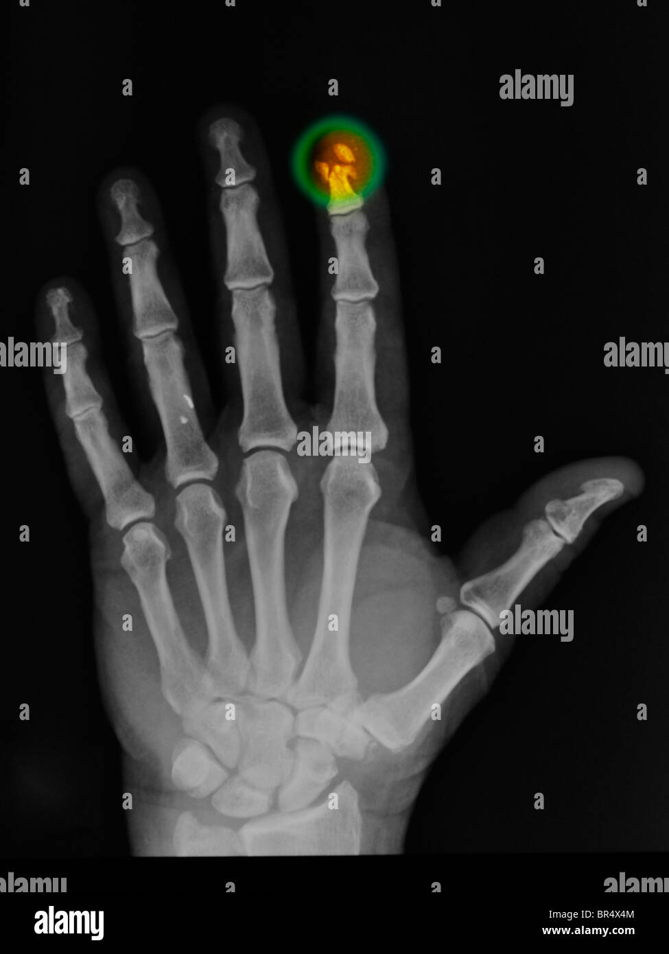 Crushed Hand X Ray