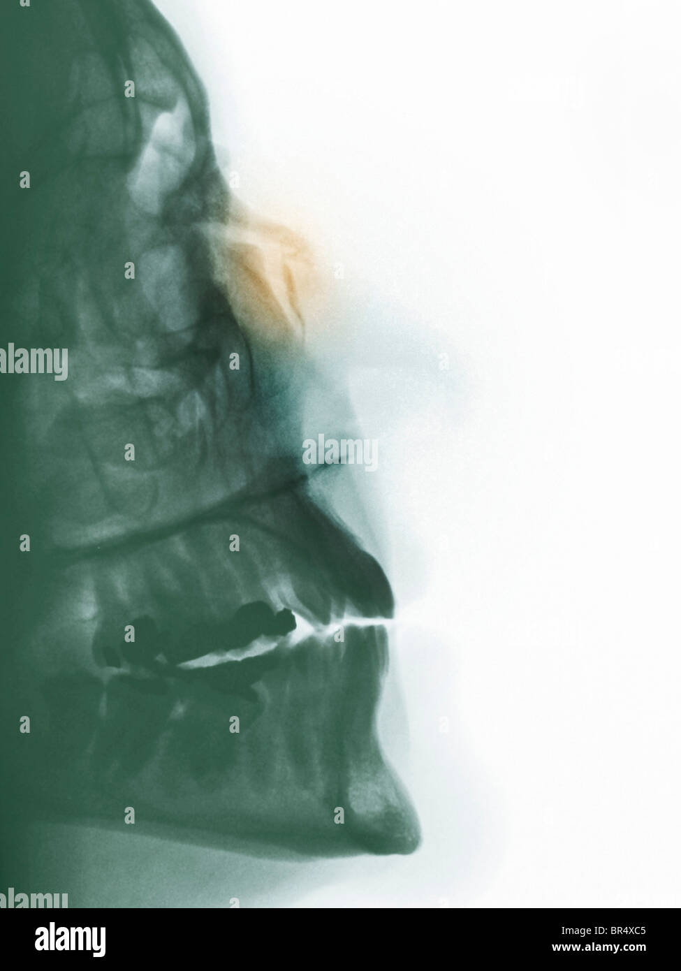 x-ray showing a fractured nose in a woman who fell Stock Photo - Alamy