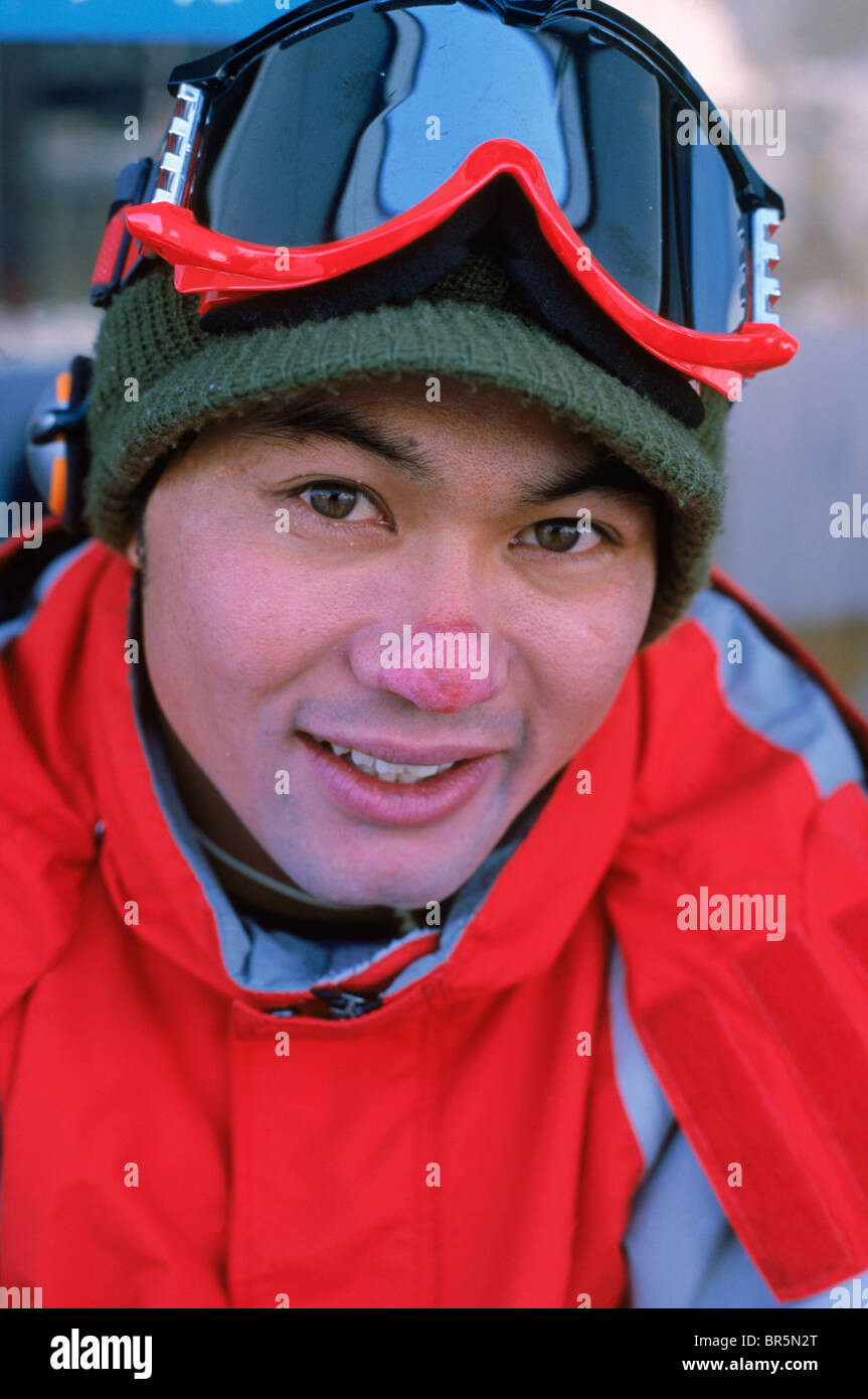 Frostbitten Nose Black Frostbite | Definition, Symptoms, Stages,