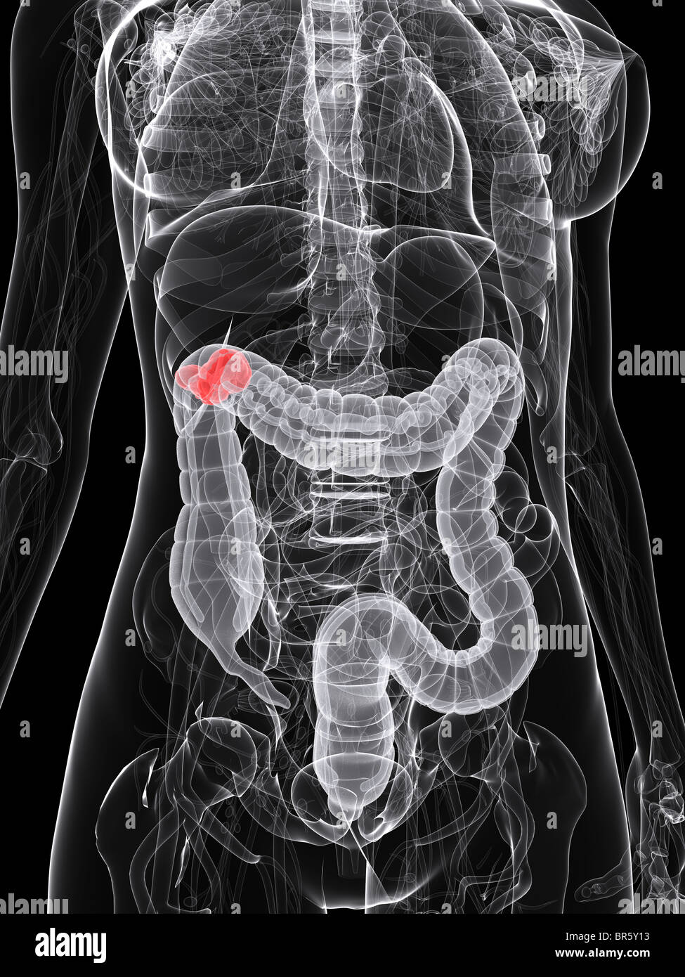 Bowel cancer hi-res stock photography and images - Alamy