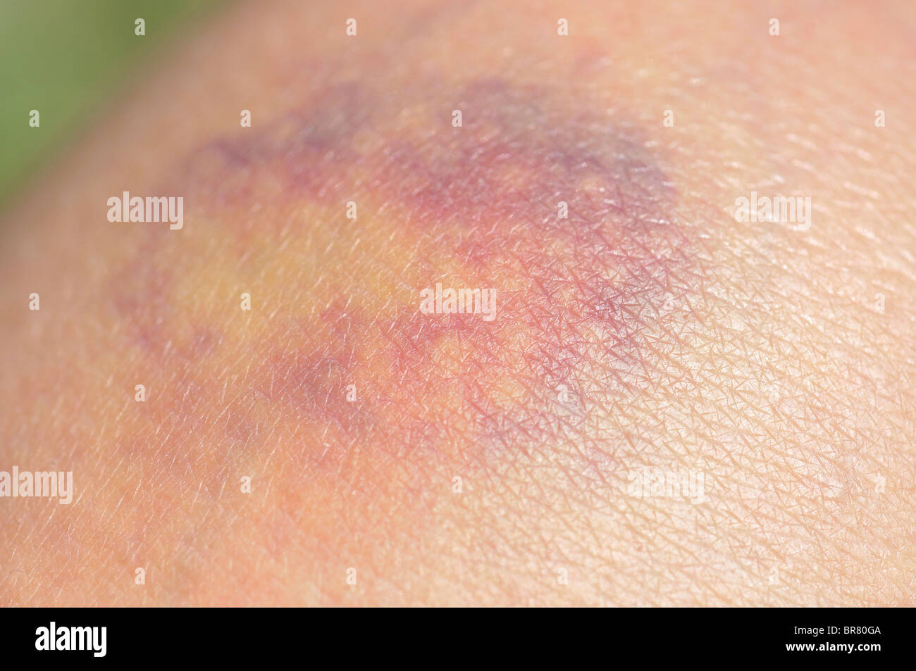 Bruised woman's skin Stock Photo - Alamy