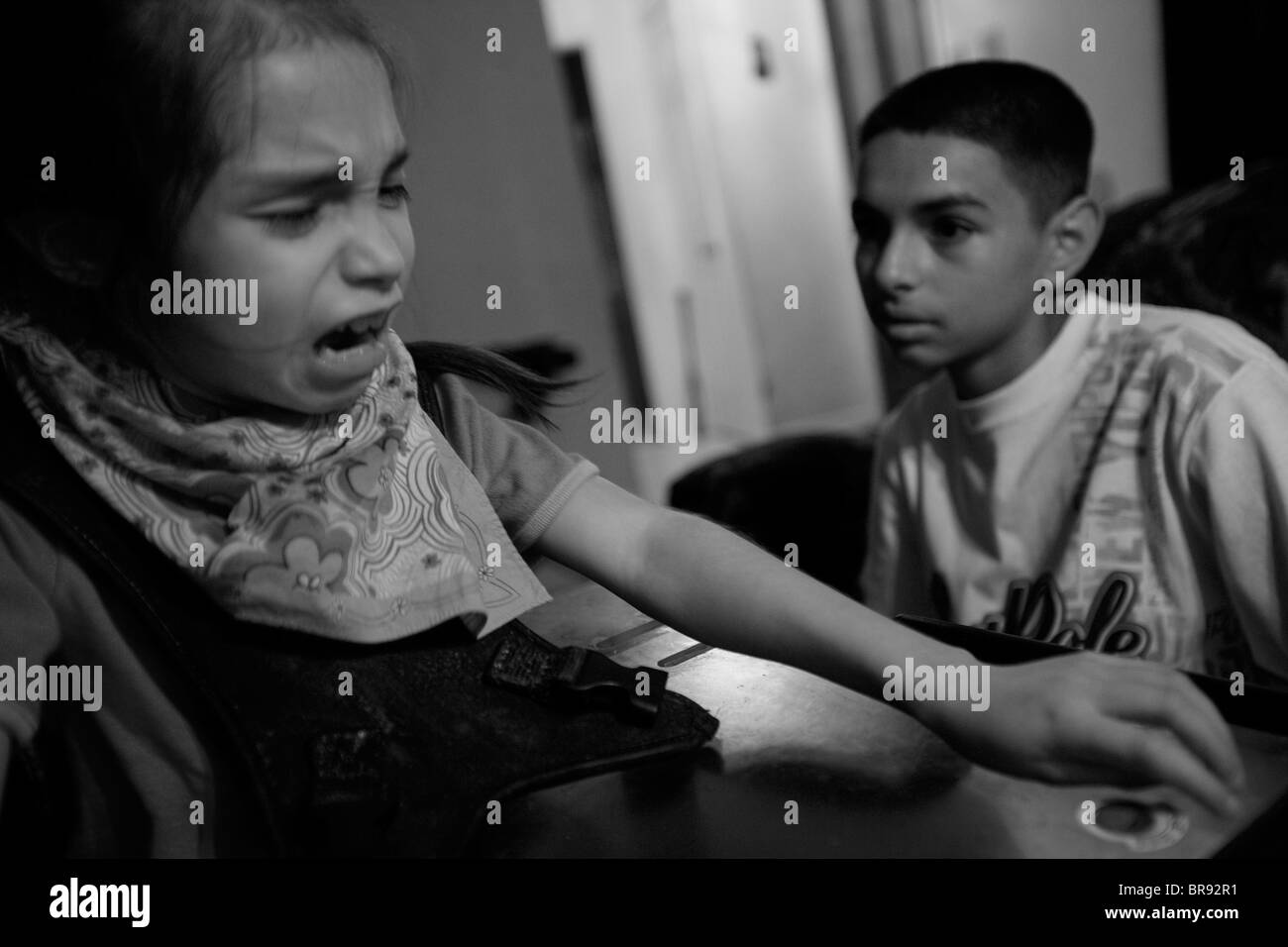 Hand birth defect Black and White Stock Photos & Images - Alamy