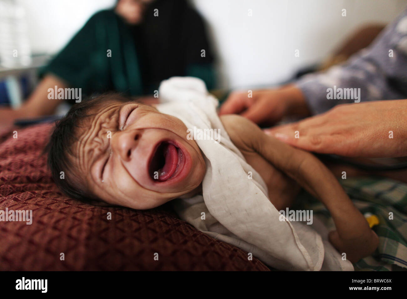 malnutrition among patients in a pediatric ward of a hospital Afghan ...