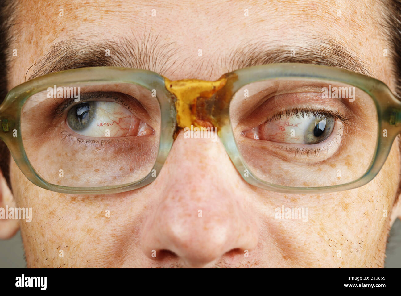 A person suffering from a severe form of strabismus - eye closeup Stock ...