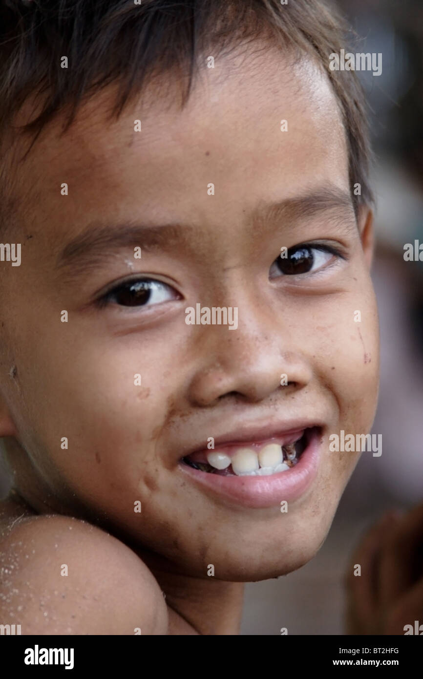 A young Asian boy with rotting teeth is smiling as he poses for a ...
