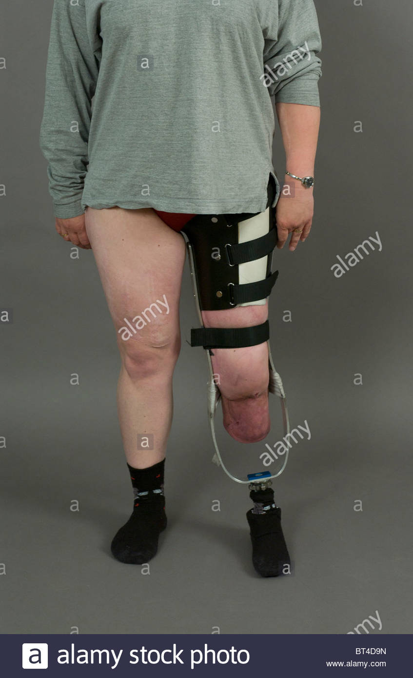 Prosthesis Handicapped Disabled Amputee Stock Photos & Prosthesis ...