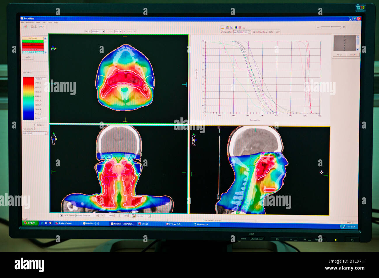 Computer monitor in hospital oncology department showing CT images ...