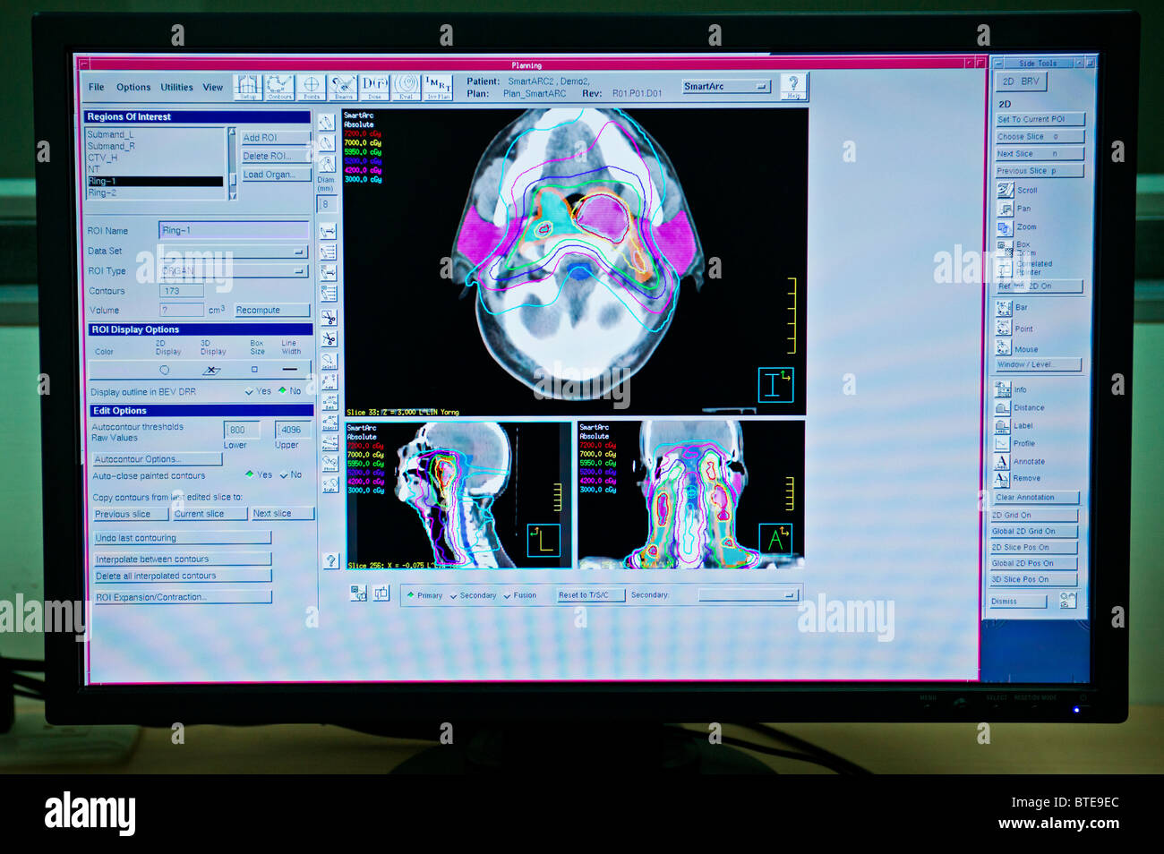 Computer monitor in hospital oncology department showing CT images ...