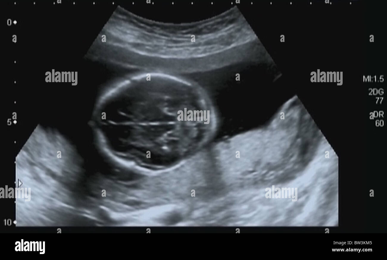 Obstetric Ultrasonography of Fourth Month Fetus Stock Photo - Alamy