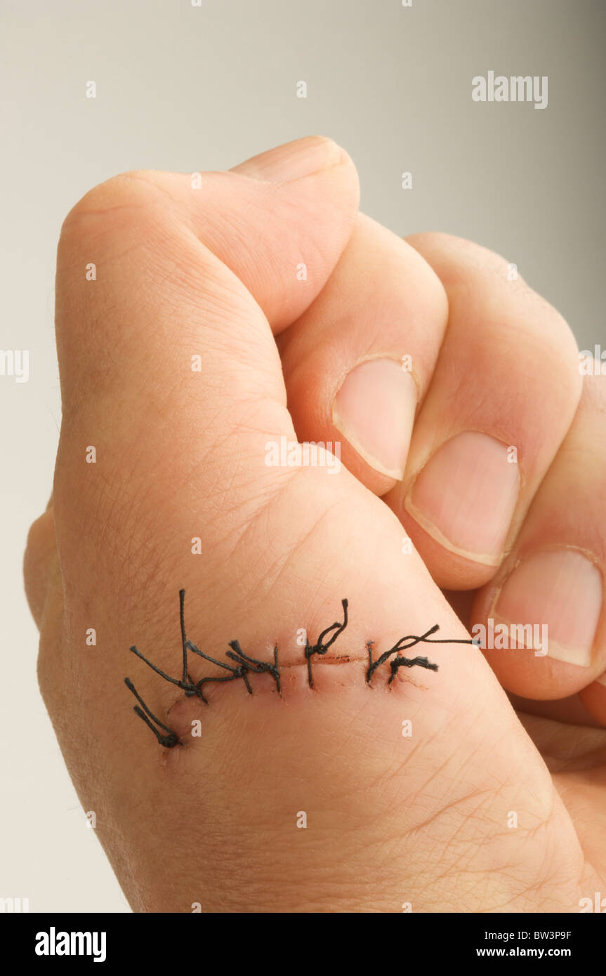 Person With Stitches On Hand Holding By Tamara Staples