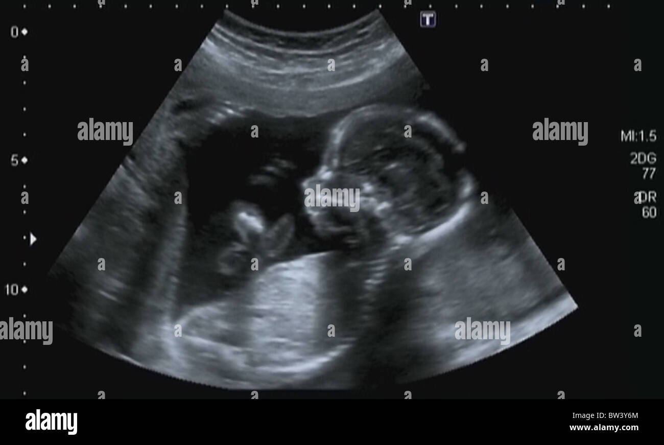 Obstetric Ultrasonography of Fourth Month Fetus Stock Photo - Alamy