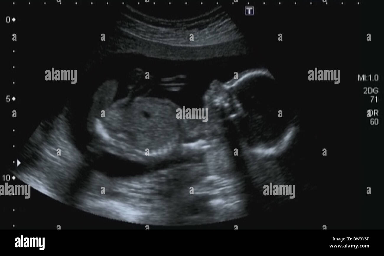 Obstetric Ultrasonography of Fourth Month Fetus Stock Photo - Alamy