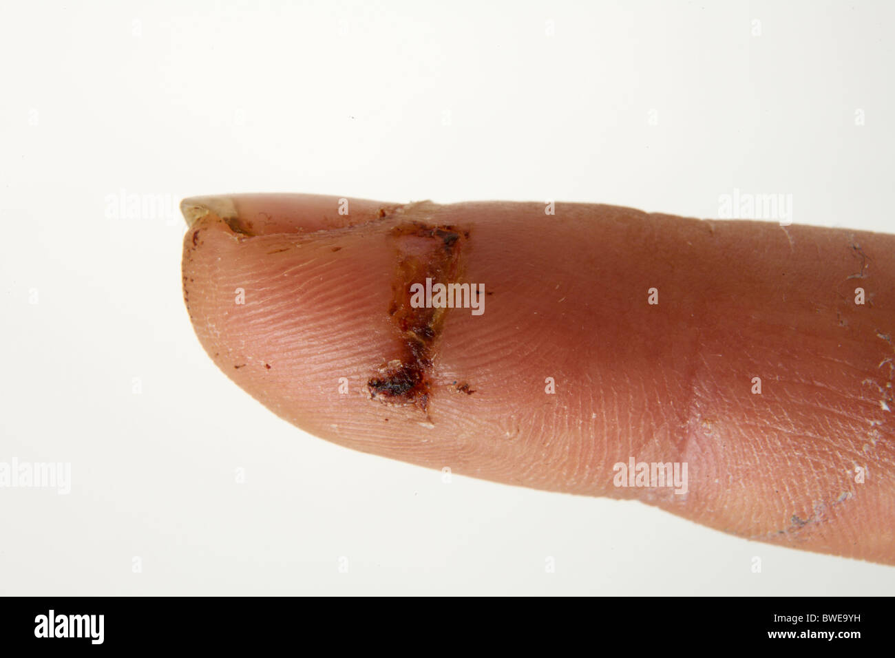 Human hand cut fingers hi-res stock photography and images - Alamy