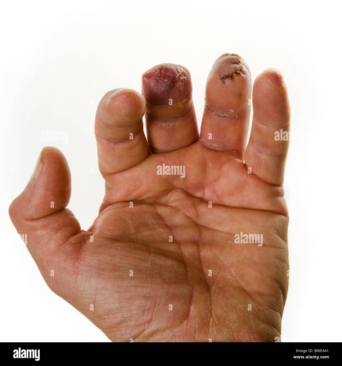 male close up of left hand on white background missing two fingers ...