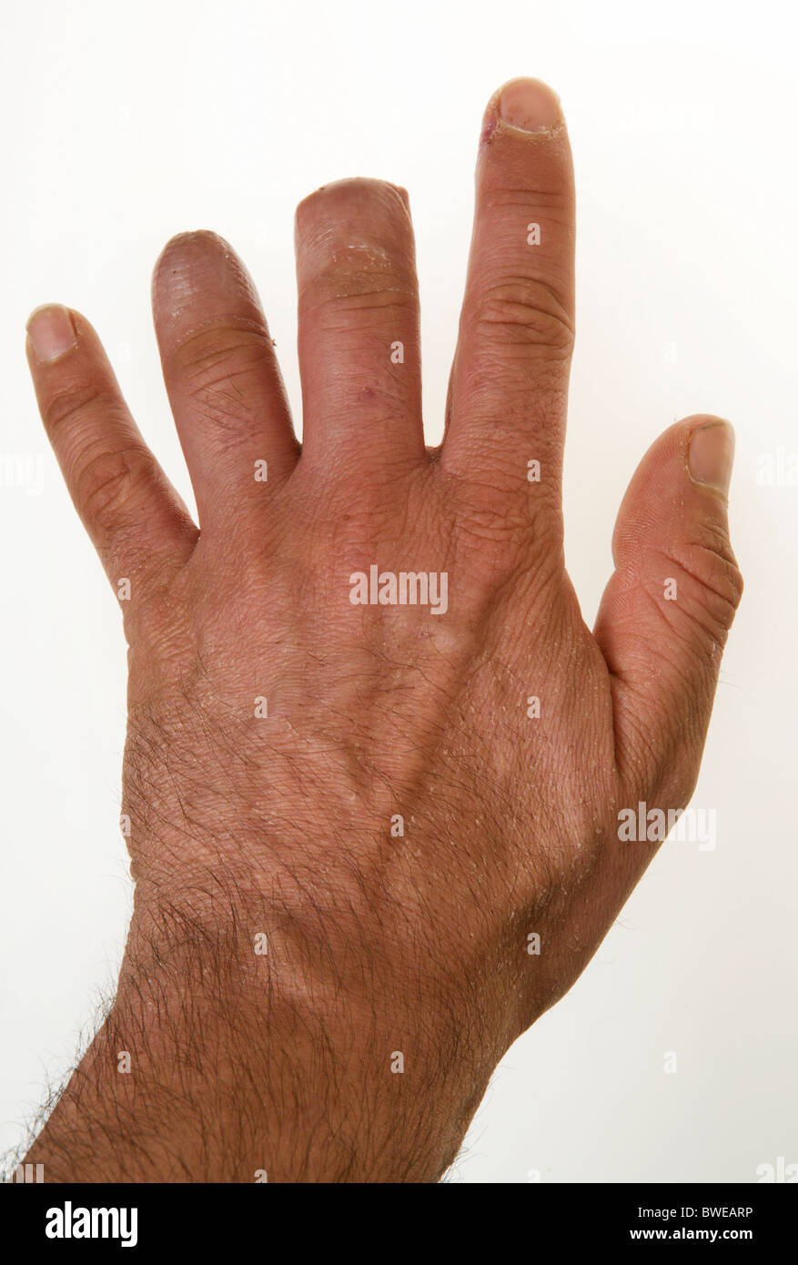 Hand missing finger hi-res stock photography and images - Alamy