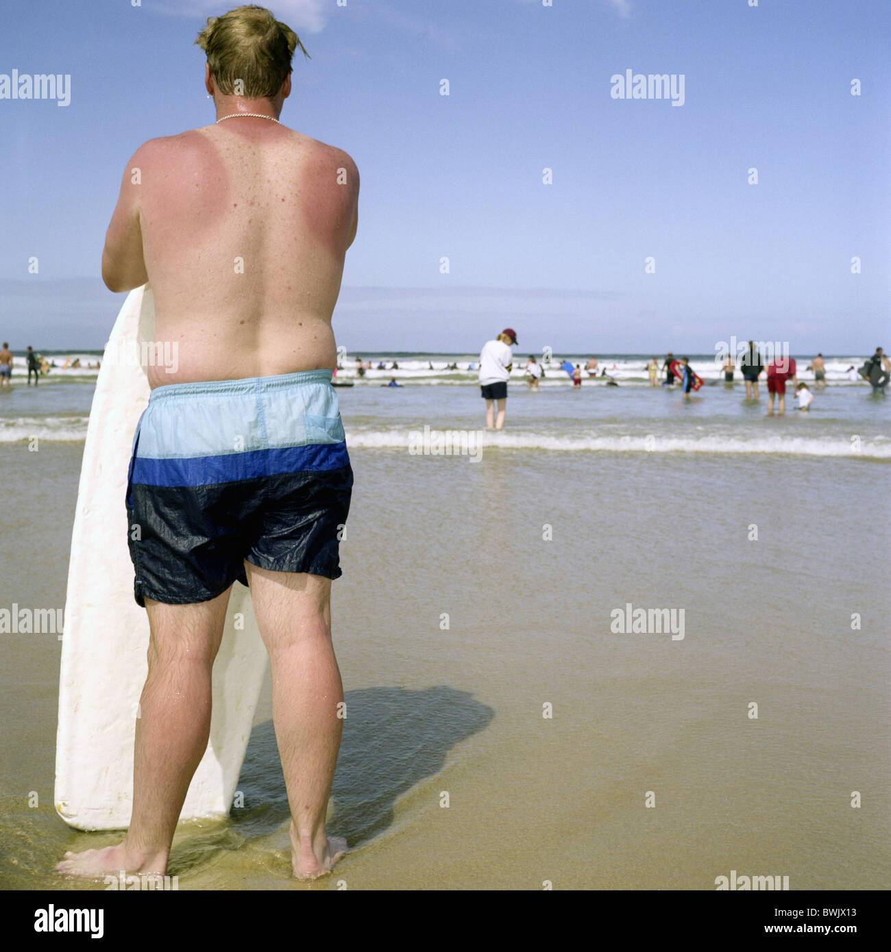 Bad sunburn hi-res stock photography and images - Alamy