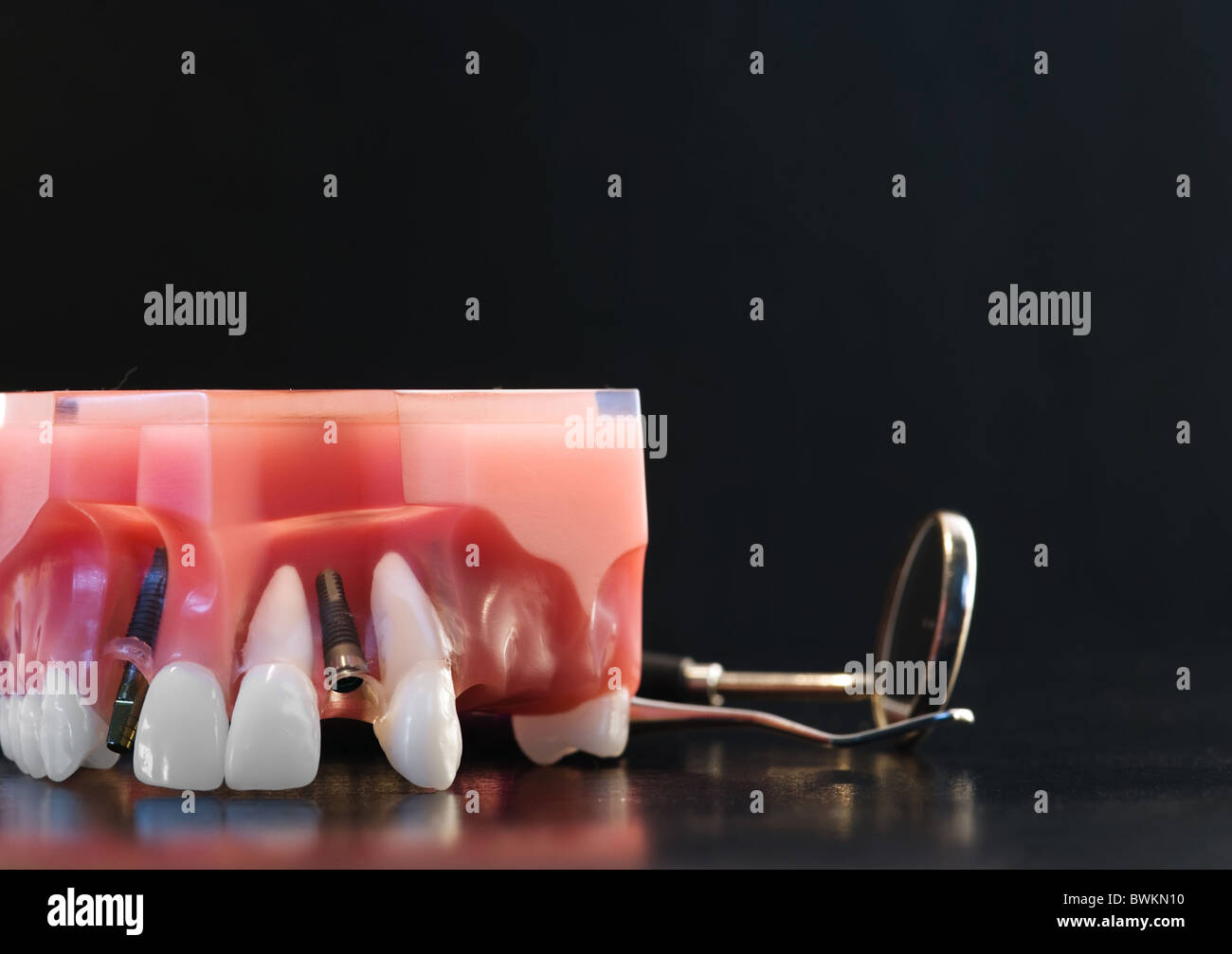 teeth implant model and dental instruments Stock Photo - Alamy
