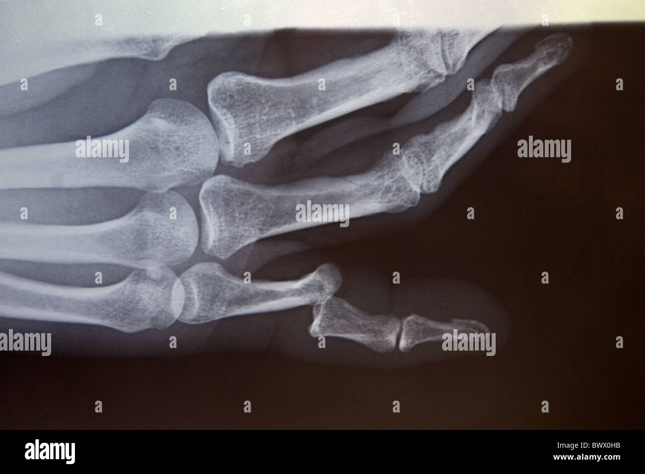 X-ray bones human hand with dislocated little Stock Photo - Alamy