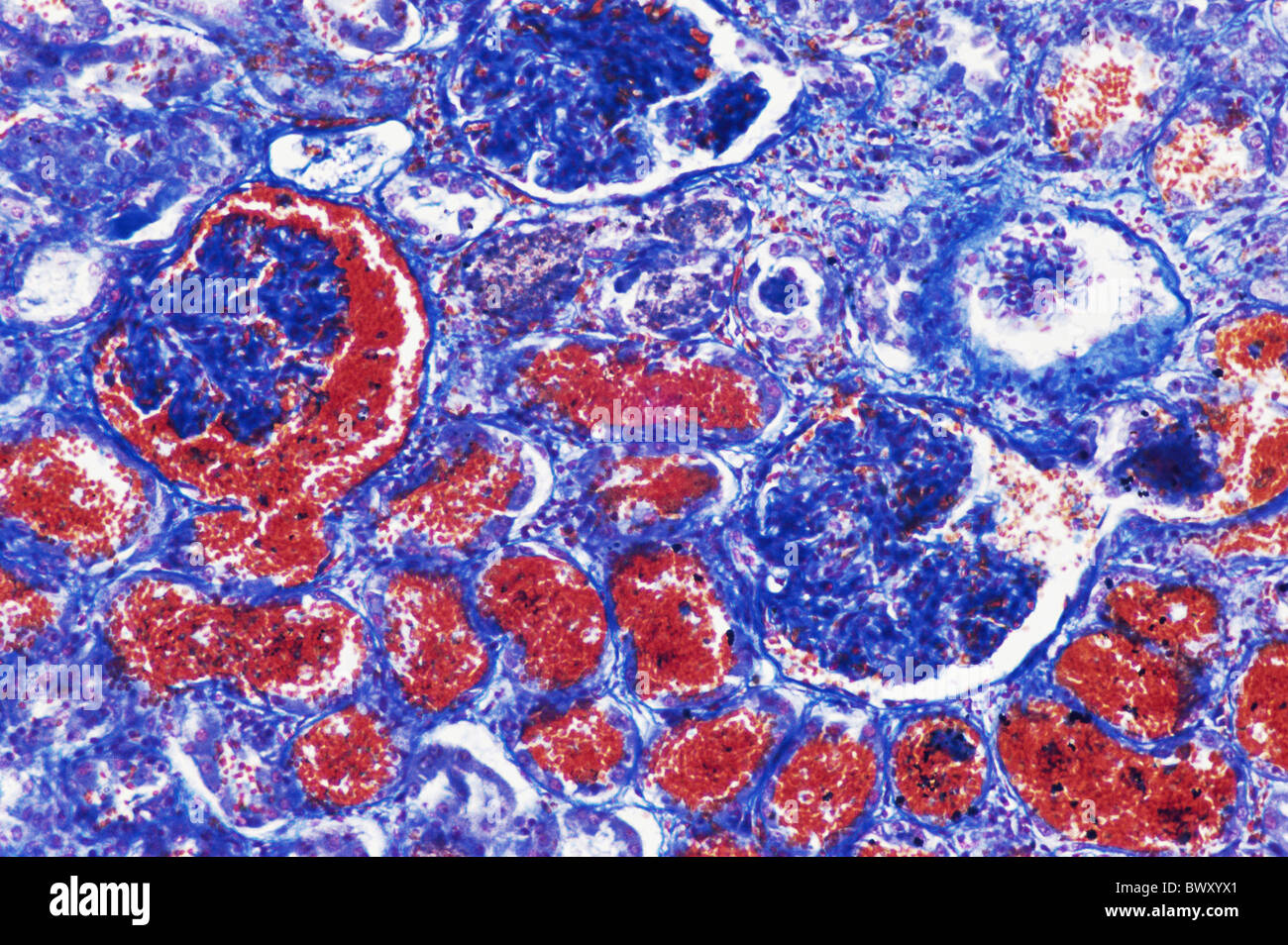 medicine microscope microscopy kidney inflammation cells Stock Photo ...