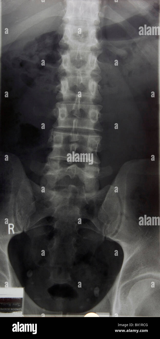 backbone hospital medicine X Ray X Ray-picture radiograph Stock Photo ...