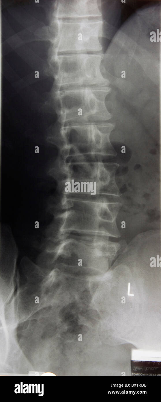 backbone hospital medicine X Ray X Ray-picture radiograph Stock Photo ...