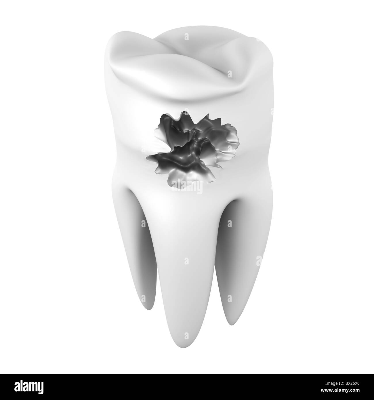 Dental caries teeth decay Black and White Stock Photos & Images - Alamy