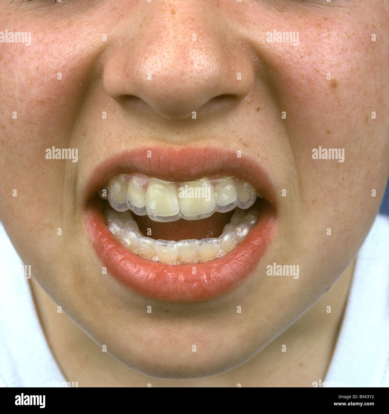 brace tooth braces clear transparently inconspicuously Invisalign tooth ...