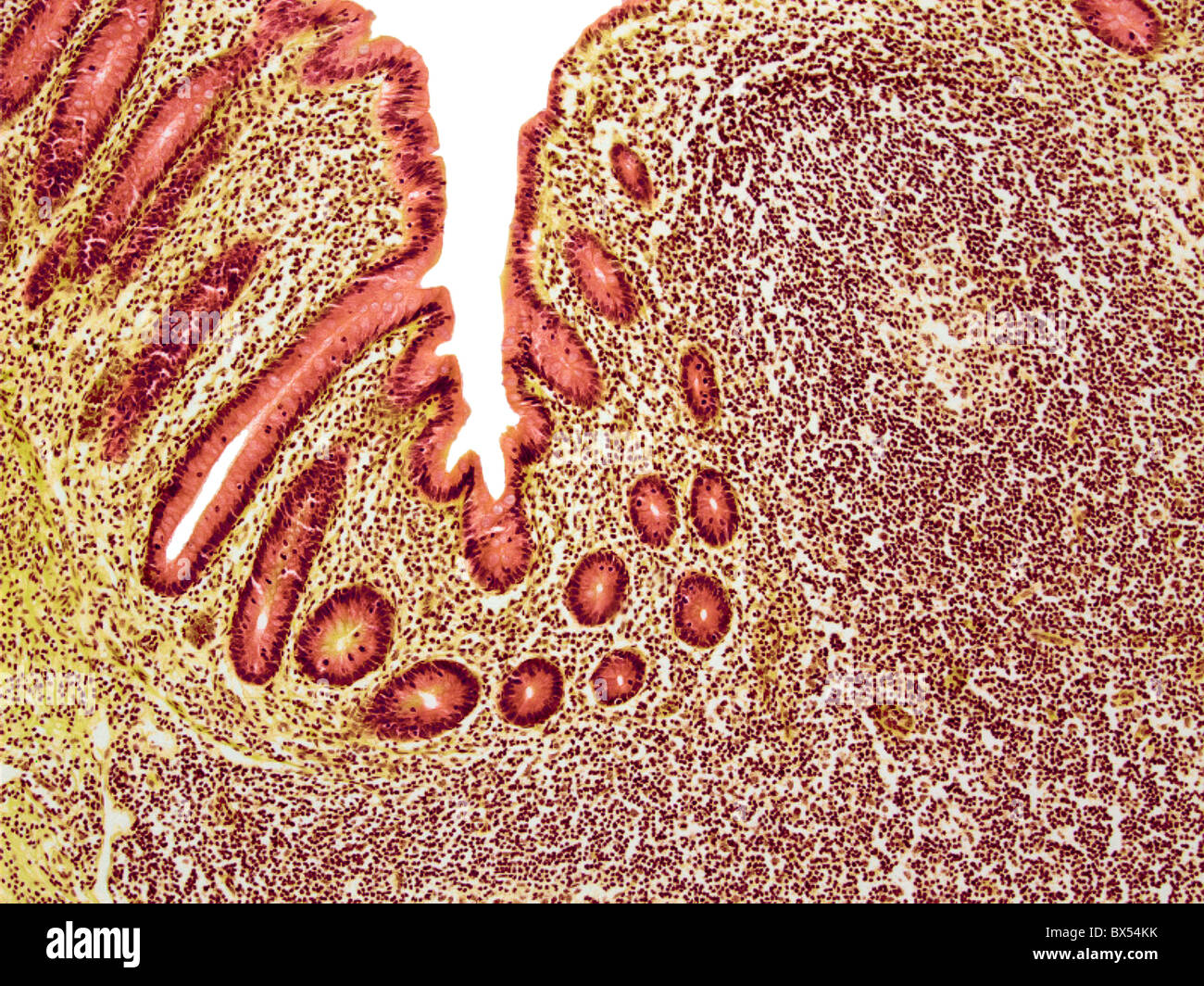 Appendicitis hi-res stock photography and images - Alamy