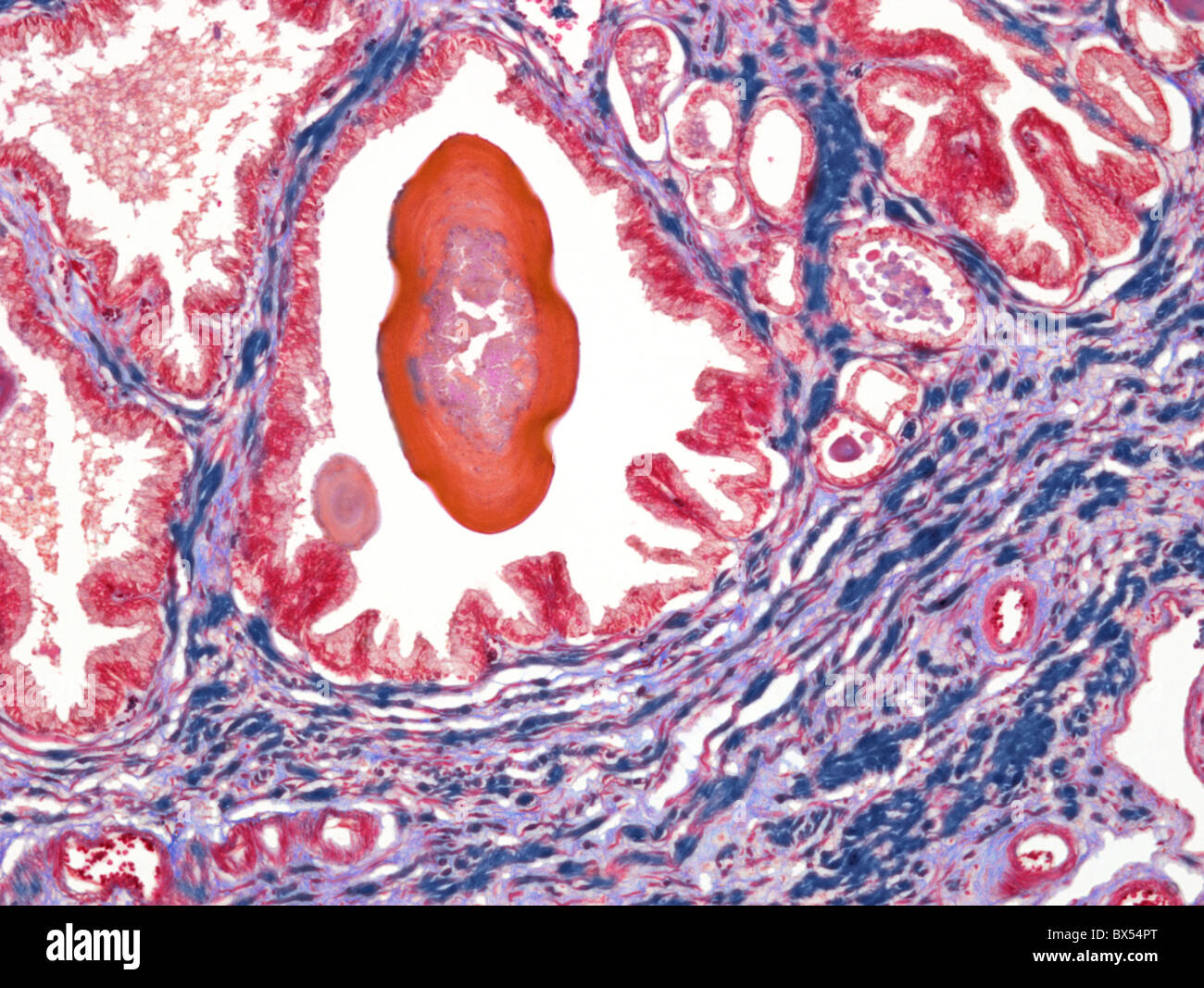 Prostate hi-res stock photography and images - Alamy