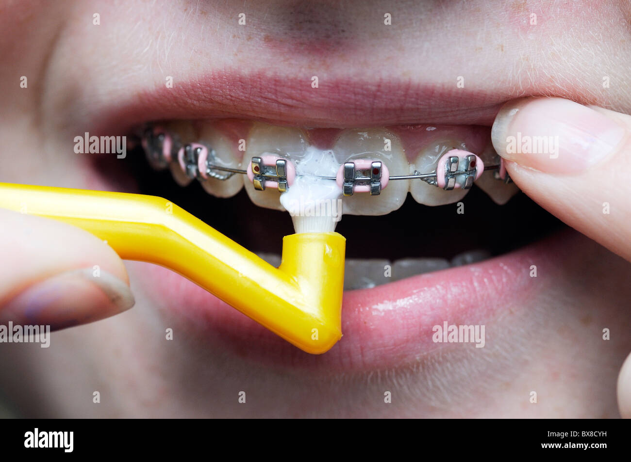Dental wires hi-res stock photography and images - Alamy