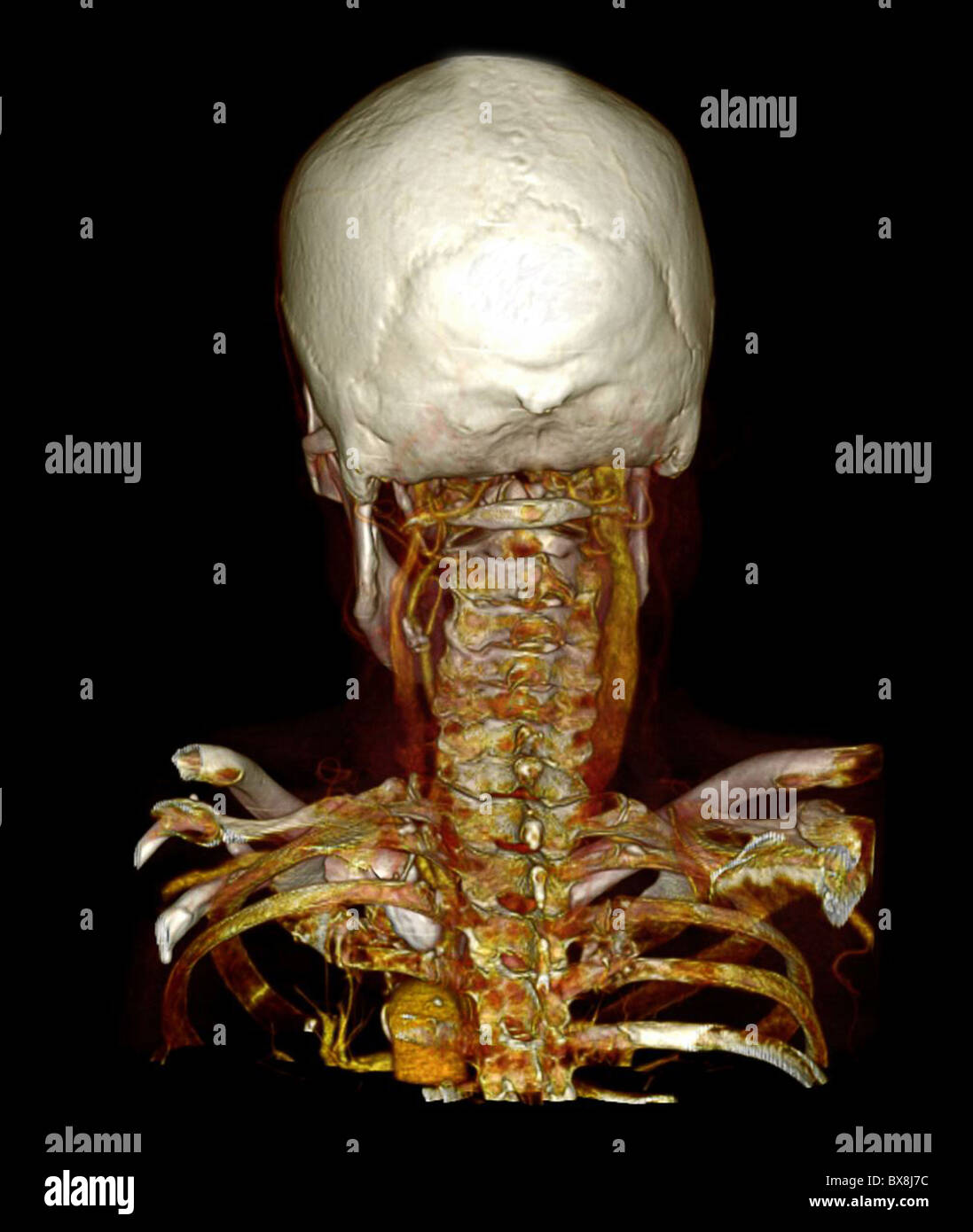 3D CT scan of the head of an elderly man Stock Photo - Alamy