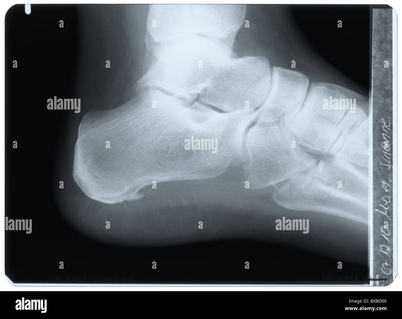 Plantar fasciitis hi-res stock photography and images - Alamy