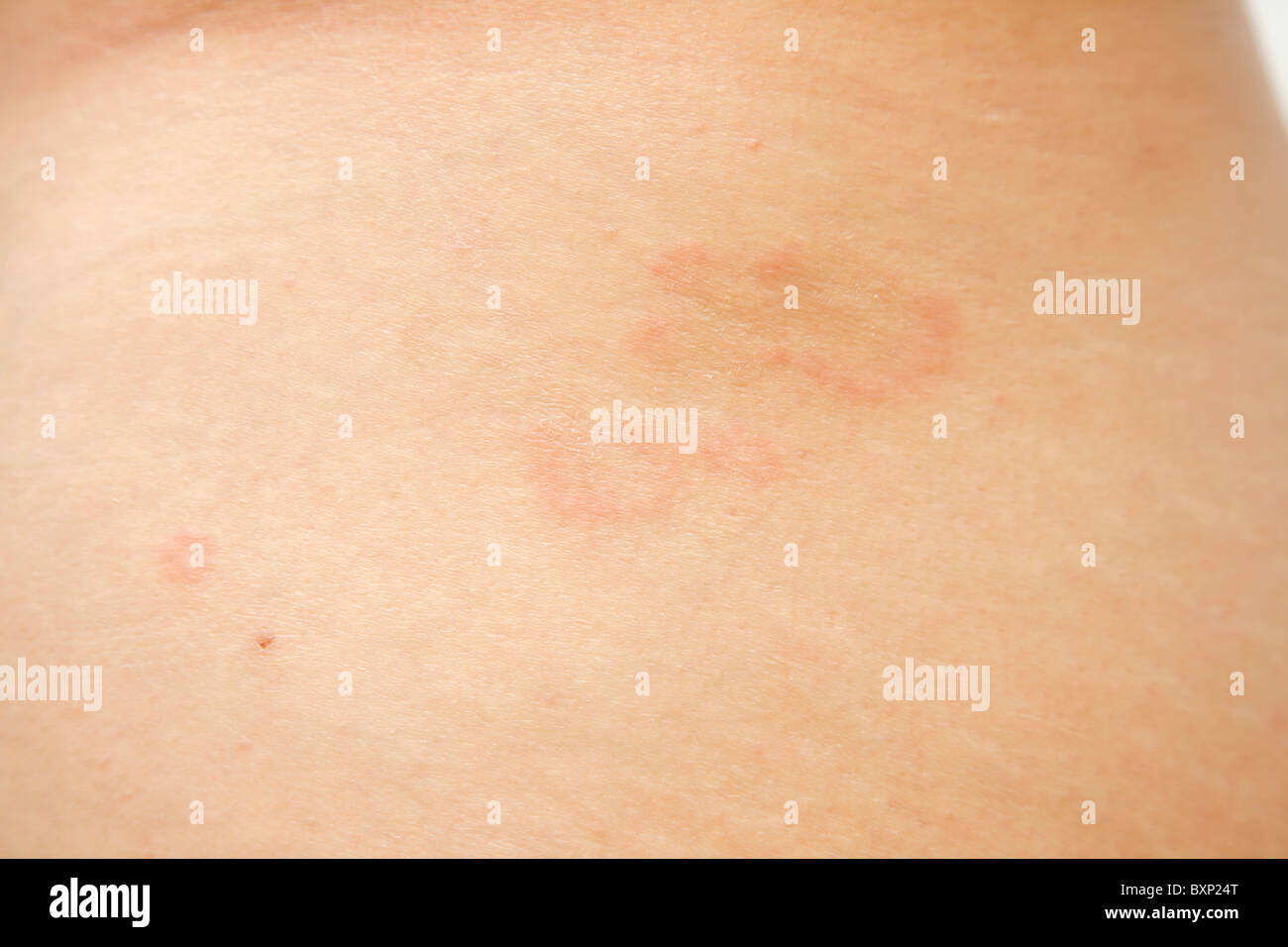 mild psoriasis on skin on side of hip Stock Photo - Alamy