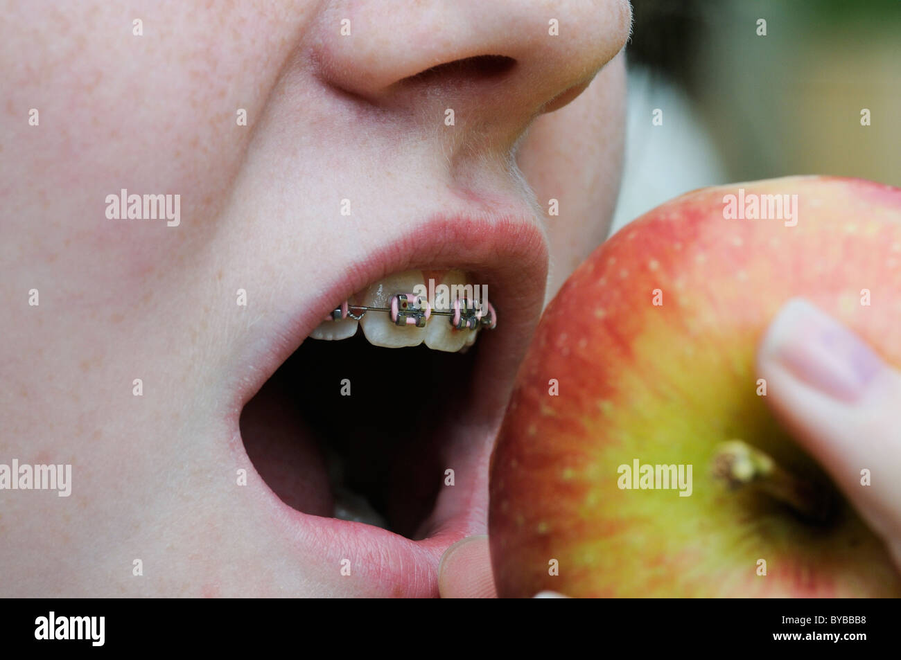 Young girl with dental brace eating an apple Stock Photo - Alamy