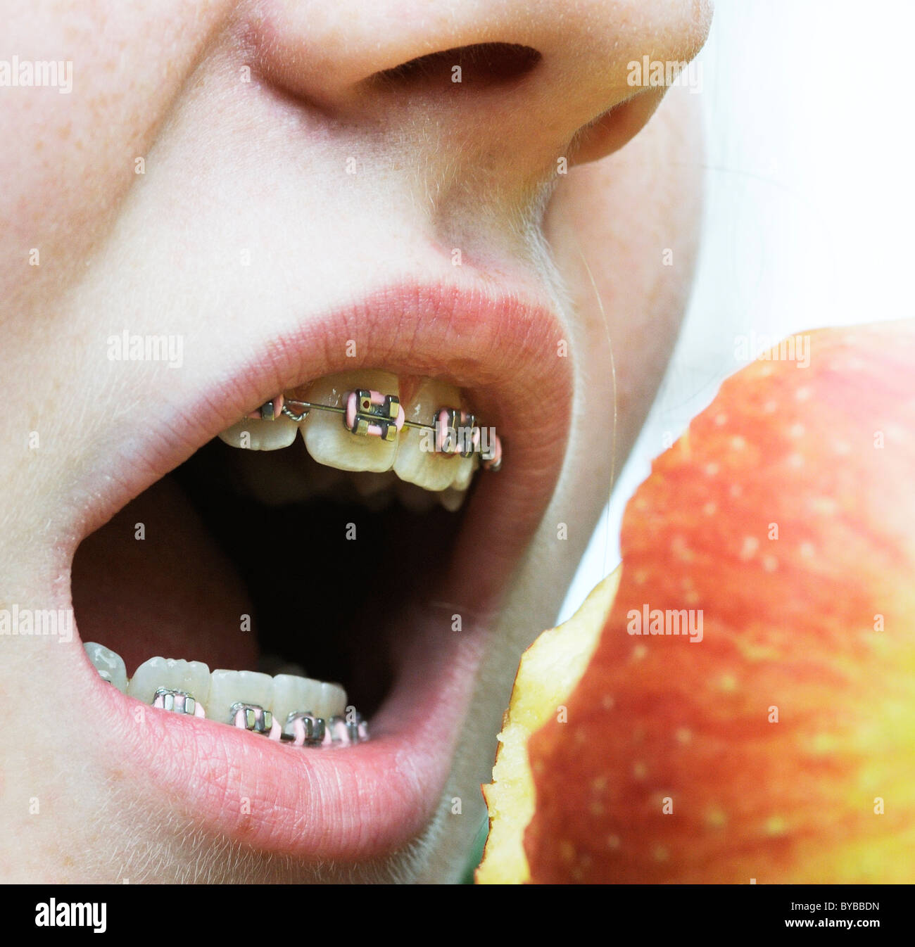 Young girl with dental brace eating an apple Stock Photo - Alamy