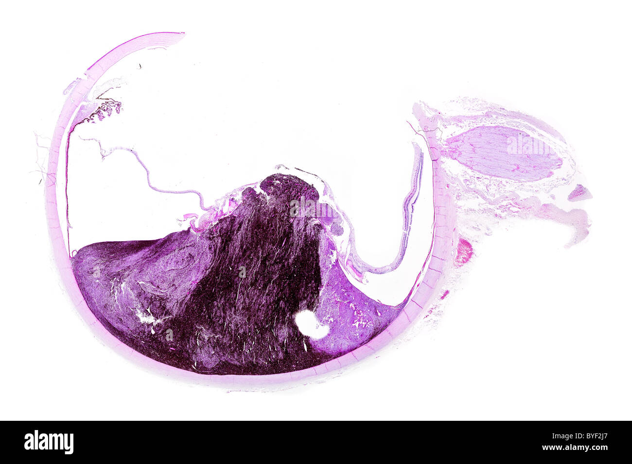 Brightfield photomicrograph, human eye section with melanotic tumor ...