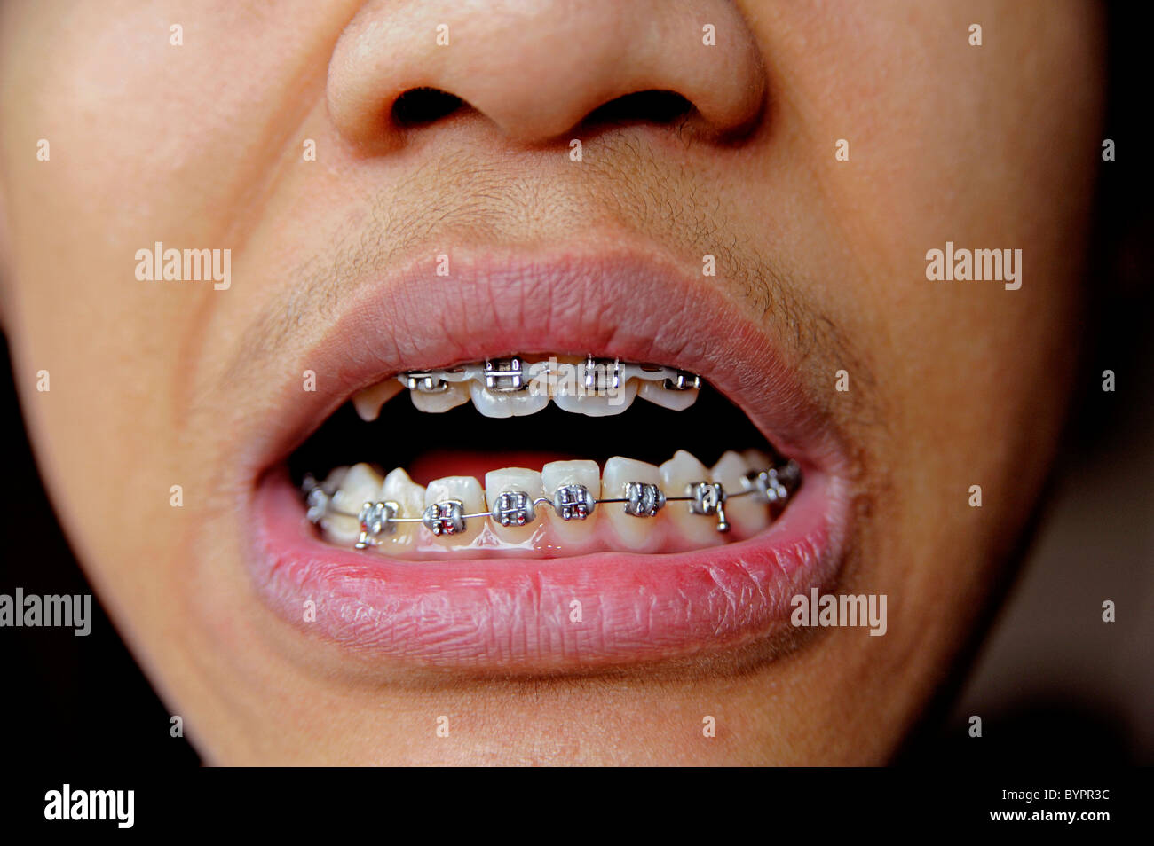 Braces Colors For Boys