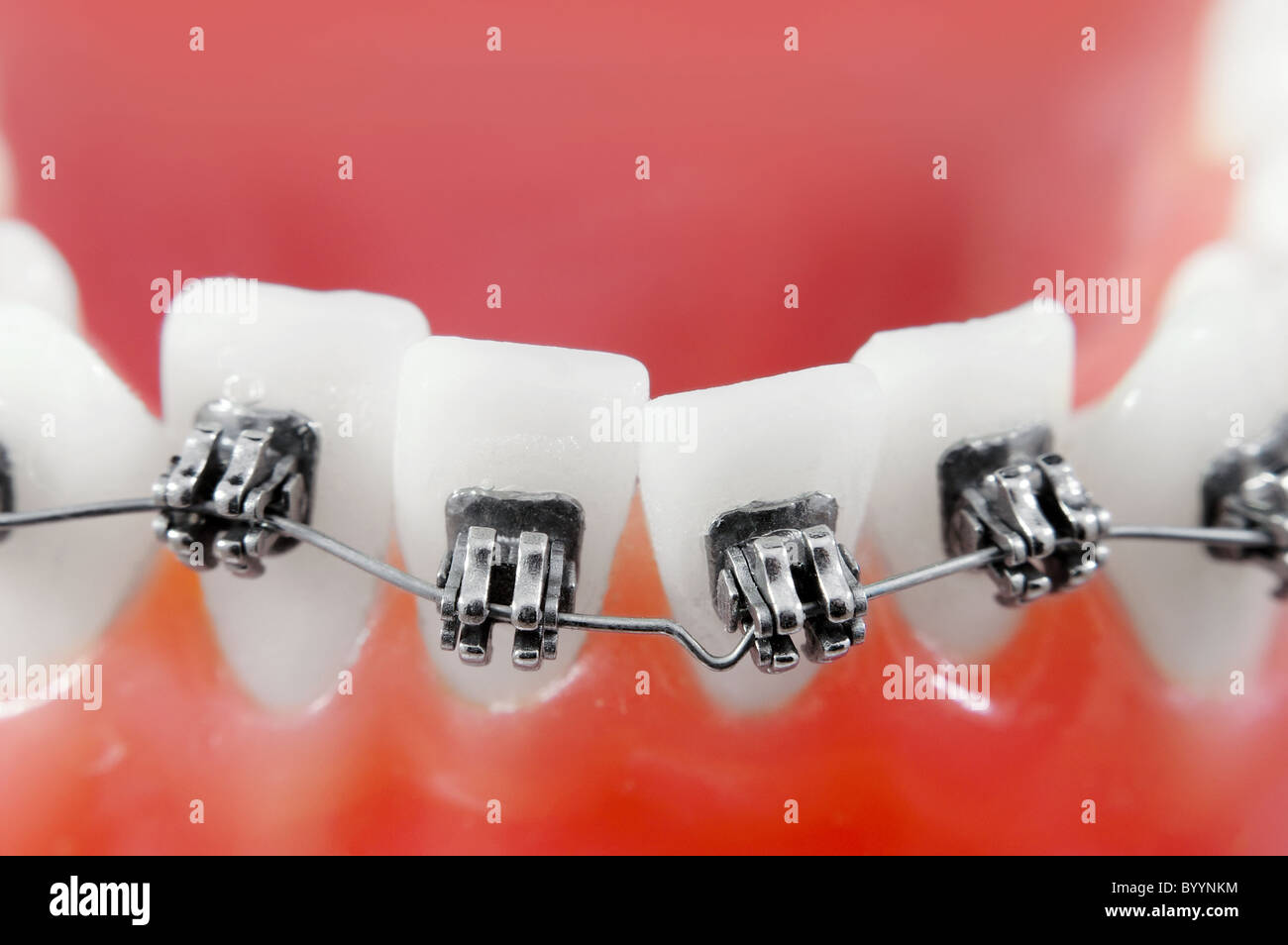 Dental braces super macro , crooked teeth , shallow depth of field ...
