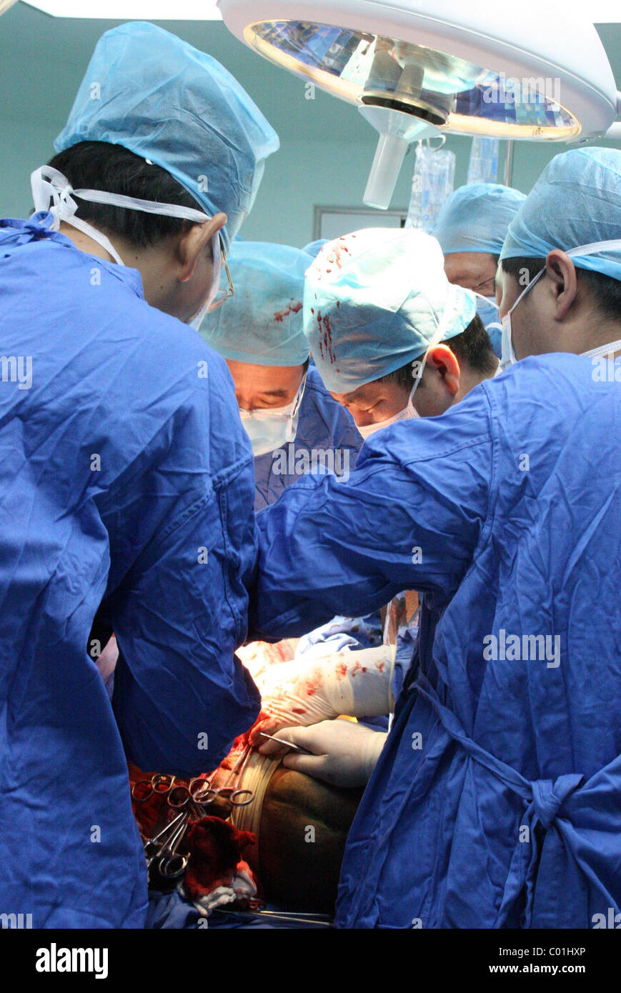 CHINESE 'ELEPHANT MAN' SURGERY A SUCCESS A Chinese patient dubbed 'the ...