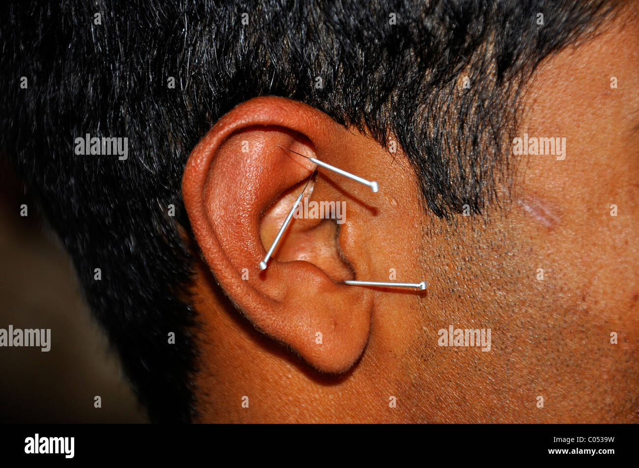 Accupuncture hi-res stock photography and images - Alamy