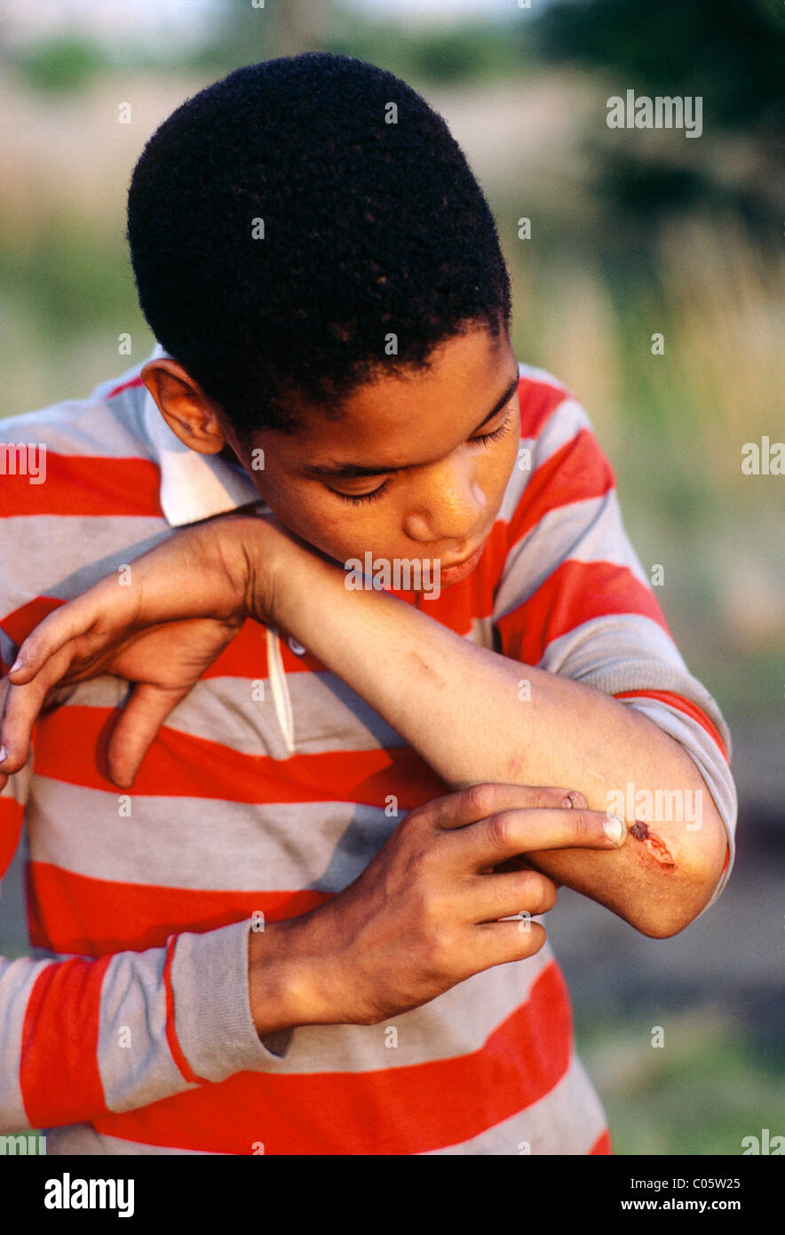 Scab scar hi-res stock photography and images - Alamy