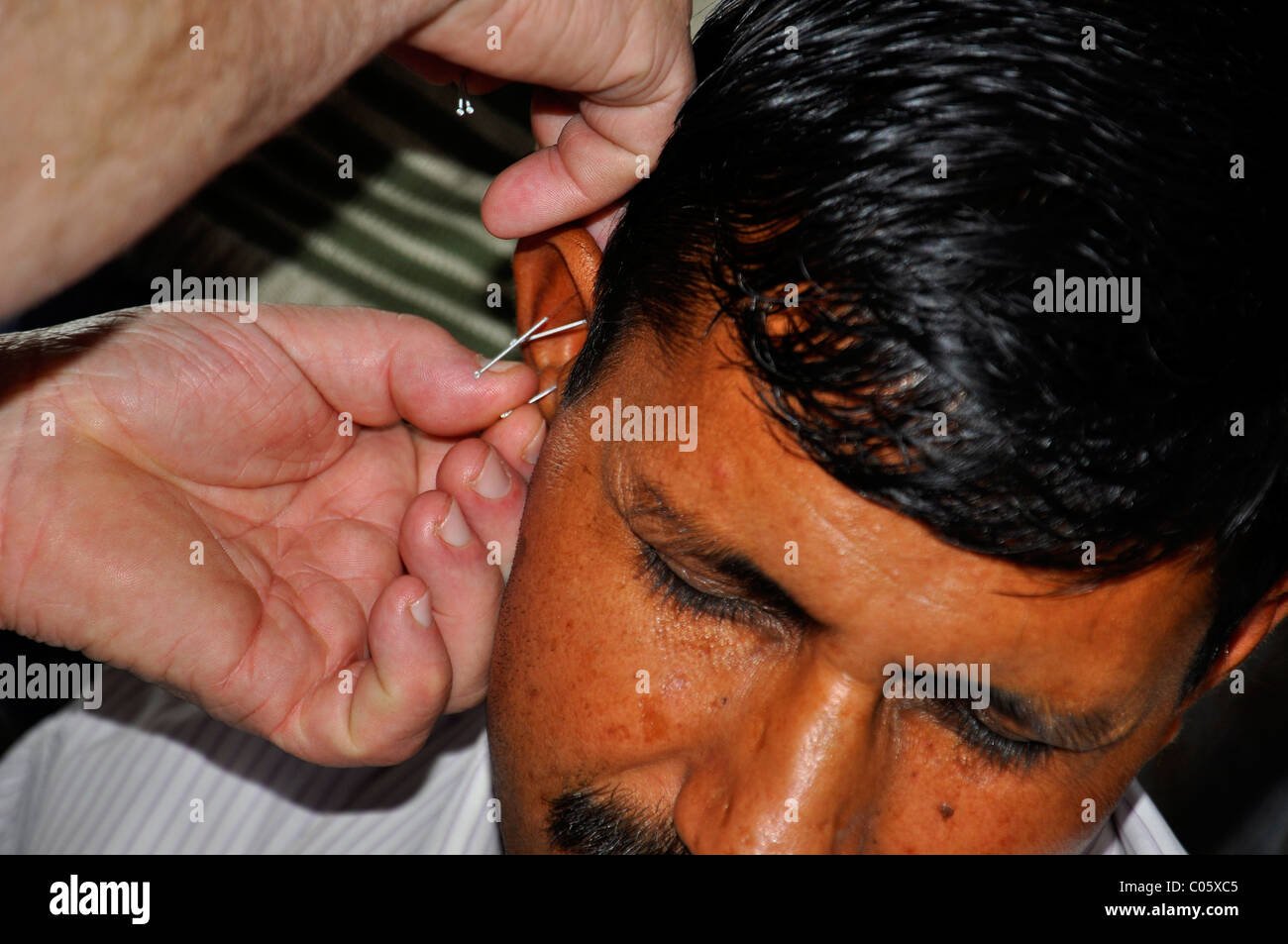 Ear acupuncture hi-res stock photography and images - Alamy